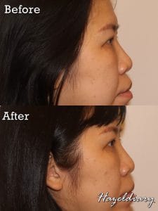 [BEAUTY REVIEW] My Ultra V Hiko Nose Thread Lift Experience with ...
