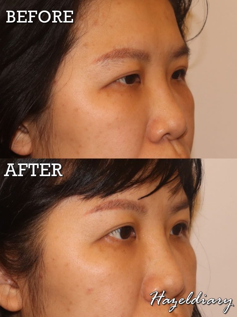 [BEAUTY REVIEW] My Ultra V Hiko Nose Thread Lift Experience with ...